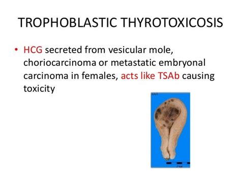 Thyrotoxicosis Complete Review Of Anatomy Physiology Types And Cli