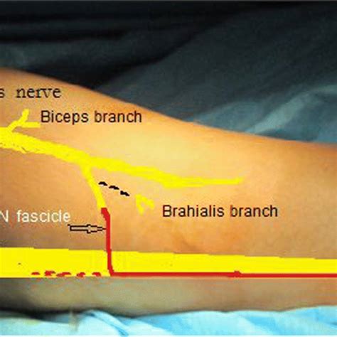 Intrafascicular Dissection Of The Median Nerve At Arm Level To Explore Ain Download Scientific