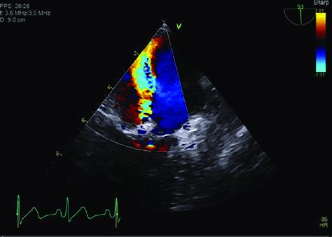 Transoesophageal Echocardiogram Showing Severe Mitral Regurgitation