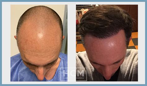 Hair Center Mexico In Tijuana Top Destination For An FUE Hair
