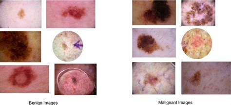 Benign Versus Malignant Images Download Scientific Diagram