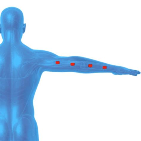 Tens Unit Pad Placement Best Practices Artofit