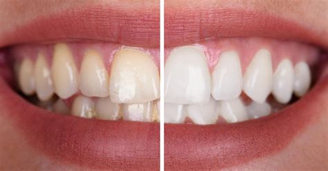 A Teeth Whitening Trend Went Viral On Tiktok — But Is It Really Safe