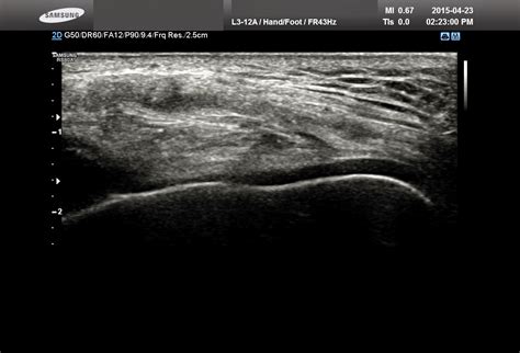 Vietnamese Medic Ultrasound Case 308 Patella Dislocation Dr Phan