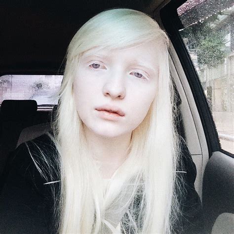 Albinonastyaalbino Girl Albino Girl Albino Human