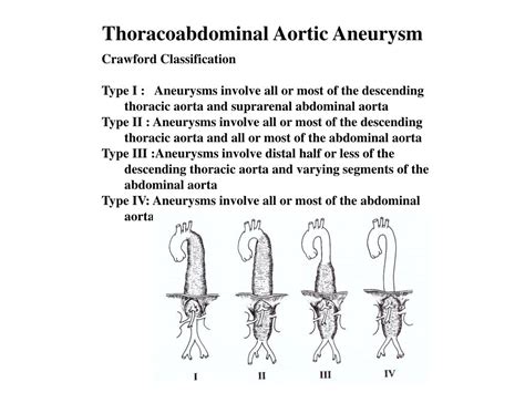 Ppt Aortic Aneurysm Powerpoint Presentation Free Download Id 6599578
