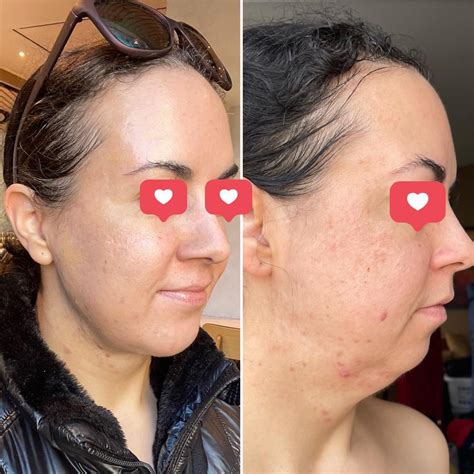 Ive Battled Cystic Acne For Years 40s What Would Help The Most