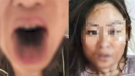 코로나 감염자 성형 안 됩니다금지령 내린 중국 왜 네이트 뉴스