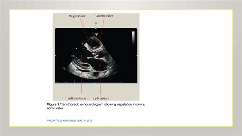 Infective Endocardititis Pptx Full Notes Pptx