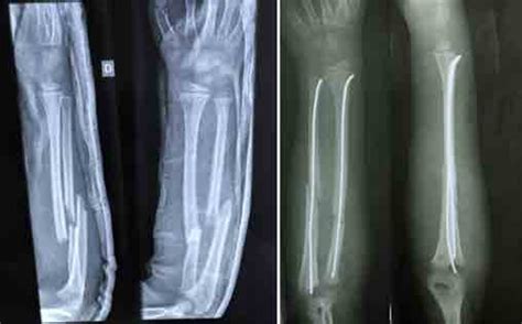 A Fratura Completa Das Diáfises Do Rádio E Da Ulna B Fixação Com