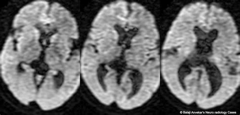 Dr Balaji Anvekar Frcr Ependymal Cyst Mri