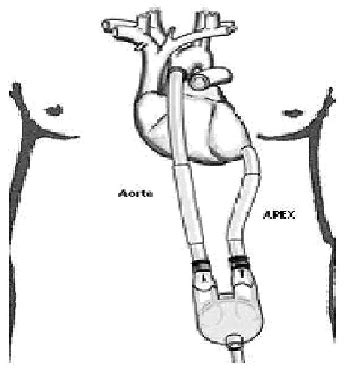 Lvad From Berlin Heart Download Scientific Diagram