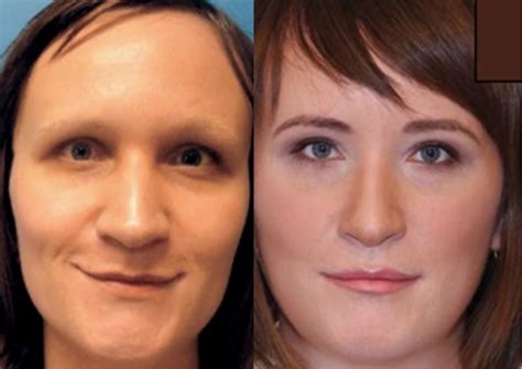 What Are All The Different Types Of Plastic Surgery At Noah Weber Blog