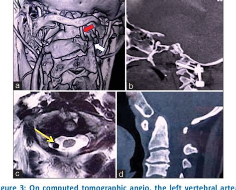 Figure 3 From C3 Segmental Vertebral Artery And Its Surgical Implication In Craniovertebral