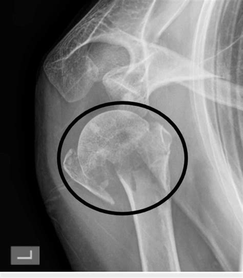 Proximal Humerus Fracture Before Reduction And Fixation Encircled Download Scientific Diagram