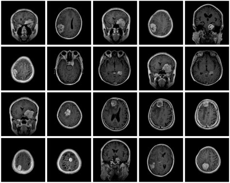 Diagnostics Free Full Text Refined Automatic Brain Tumor