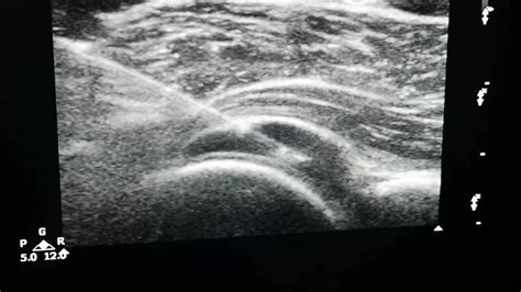 Frozen Shoulder Hydrodilatation Treatment Pain Shoulder Frozen