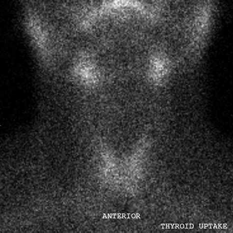 Thyroid Uptake Technetium 99m Scan A Technetium99m Scan Revealed Download Scientific Diagram