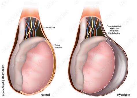 Hydrocele Testis Accumulation Of Serous Fluid In A Body Cavity Tunica