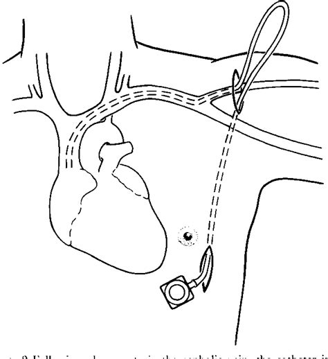 Figure 2 From Long Term Venous Access Using A Subcutaneous Implantable