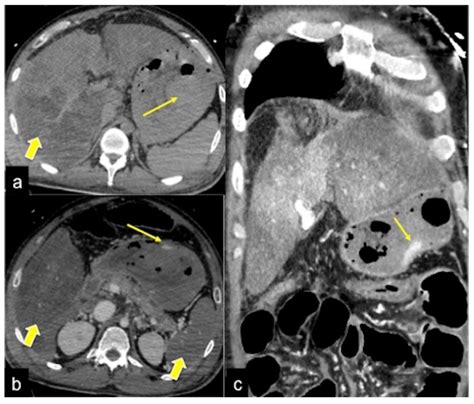 The Role Of Ct Angiography In The Acute Gastrointestinal Bleeding A