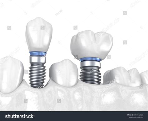 Premolar Molar Tooth Crown Installation Over Stock Illustration 1494042929