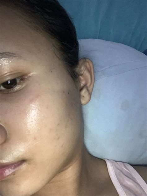 Pin By Ayu Ritaning On Breakout Acne Nose Ring Nose Acne