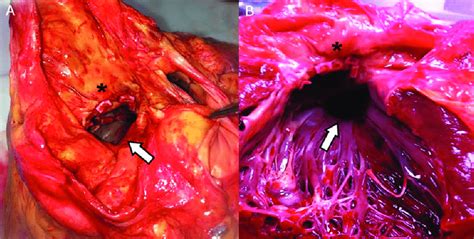 Post Mortem Examination Of The Heart A Wide Defect Below The Posterior