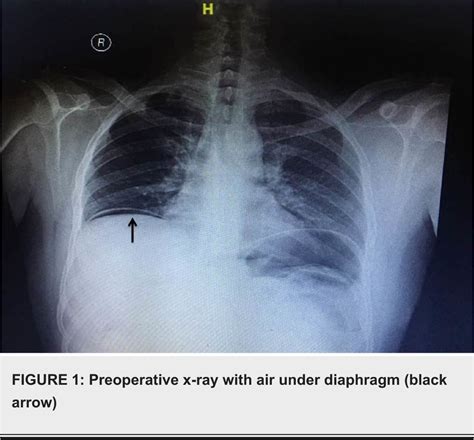 Figure 1 From Stercoral Ulcer Not Always Indolent A Rare Complication