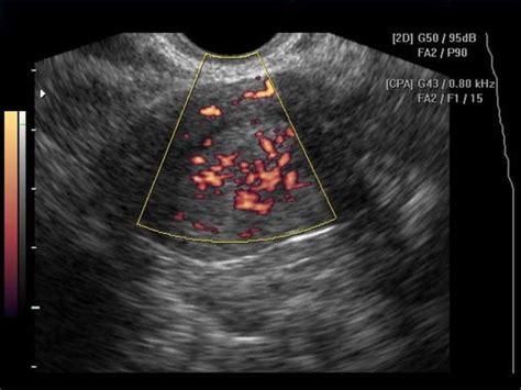 Online Cme Saline Infusion Sonohysterography Saline Infusion