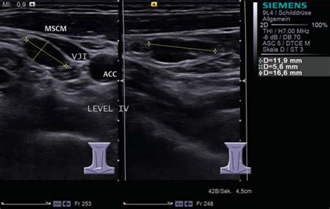 Neck Lymph Nodes Radiology Key