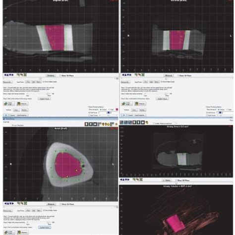 Itk Snap Software Sagital Coronal And Axial Views And Reconstructed Download Scientific