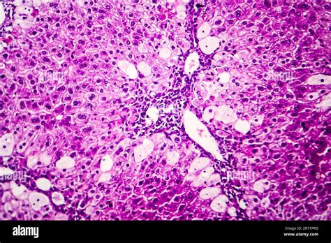 Histopathology Of Acute Hepatitis Light Micrograph Photo Under