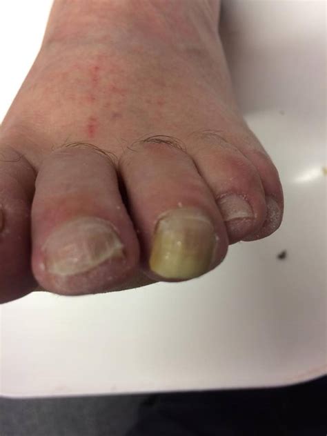 Thickened Toenails Footwear 4 U