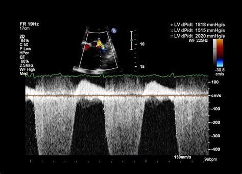 Normal Lv Systolic Function Keweenaw Bay Indian Community