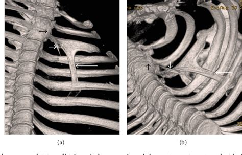 [pdf] A Unique Case Of Left Second Supernumerary And Left Third Bifid