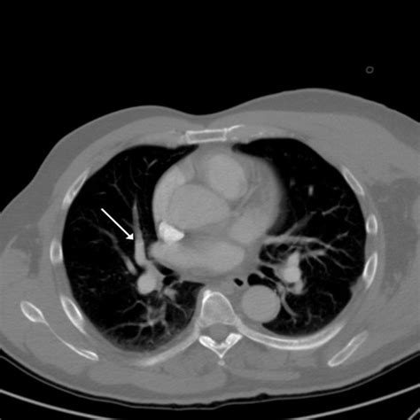 Ct Angiogram Showed A Pe Involving The Medial Segment Of The Right Download Scientific Diagram