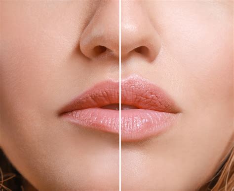 How Do Lip Injections Work Barr Aesthetics