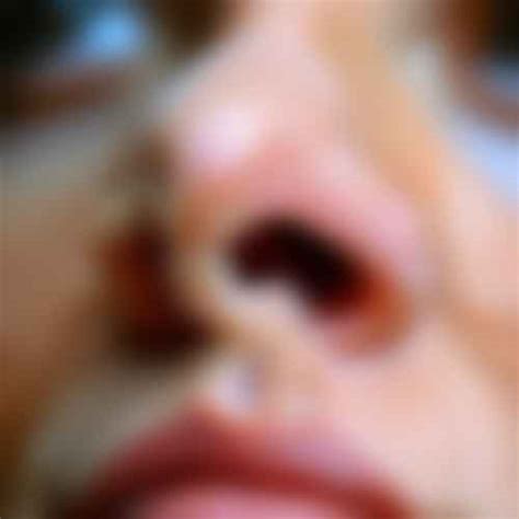 Polypen Welche Hausmittel Helfen