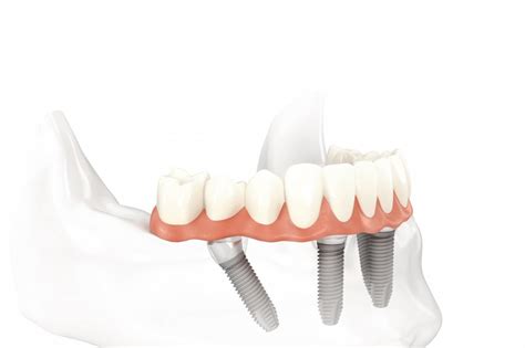 Bar Attachment Denture™ Dental Implants Greenville Sc