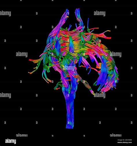 Brain Tumour Coloured 3d Diffusion Tensor Imaging Dti Scan Of The Brain Of A 64 Year Old With