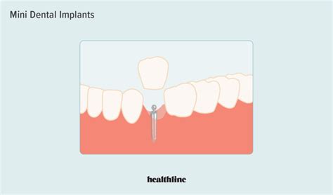 What Is The Difference Between Mini Dental Implants And Regular Implants Dental News Network