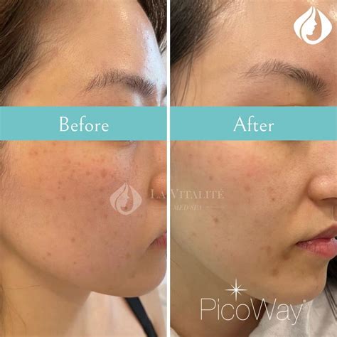 Picoway® Skin Toning And Rejuvenation Toronto North York Markham La