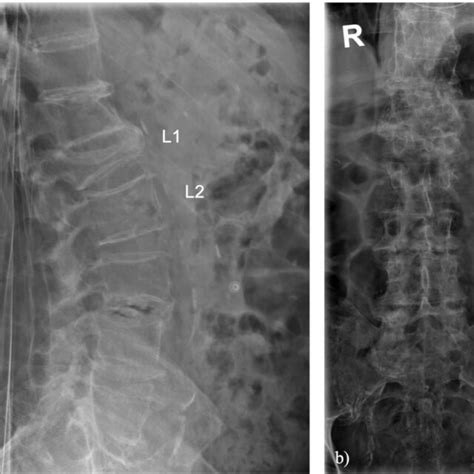 Initial Radiographs Of The Lumbar Spine As The Patient Presented In The