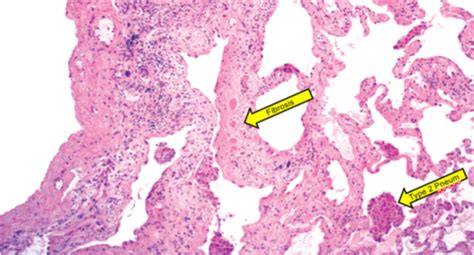 Interstitial Lung Diseases Diffuse Lung Parenchymal Lung Diseases