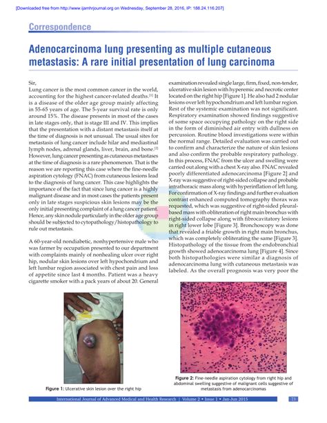 Pdf Adenocarcinoma Lung Presenting As Multiple Cutaneous Metastasis