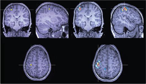 New Technique Fine Tunes Treatment For Epilepsy Patients