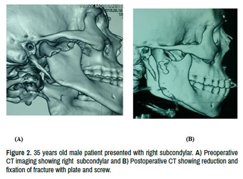 Surgery Subcondylar