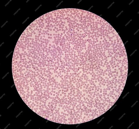 Premium Photo Hematological Slide Under Microscopy Showing
