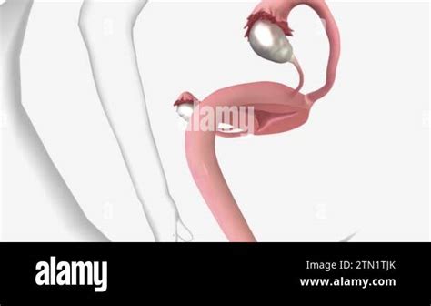 Cervical Cancer Symptoms And Signs Blood Spots Or Light Bleeding